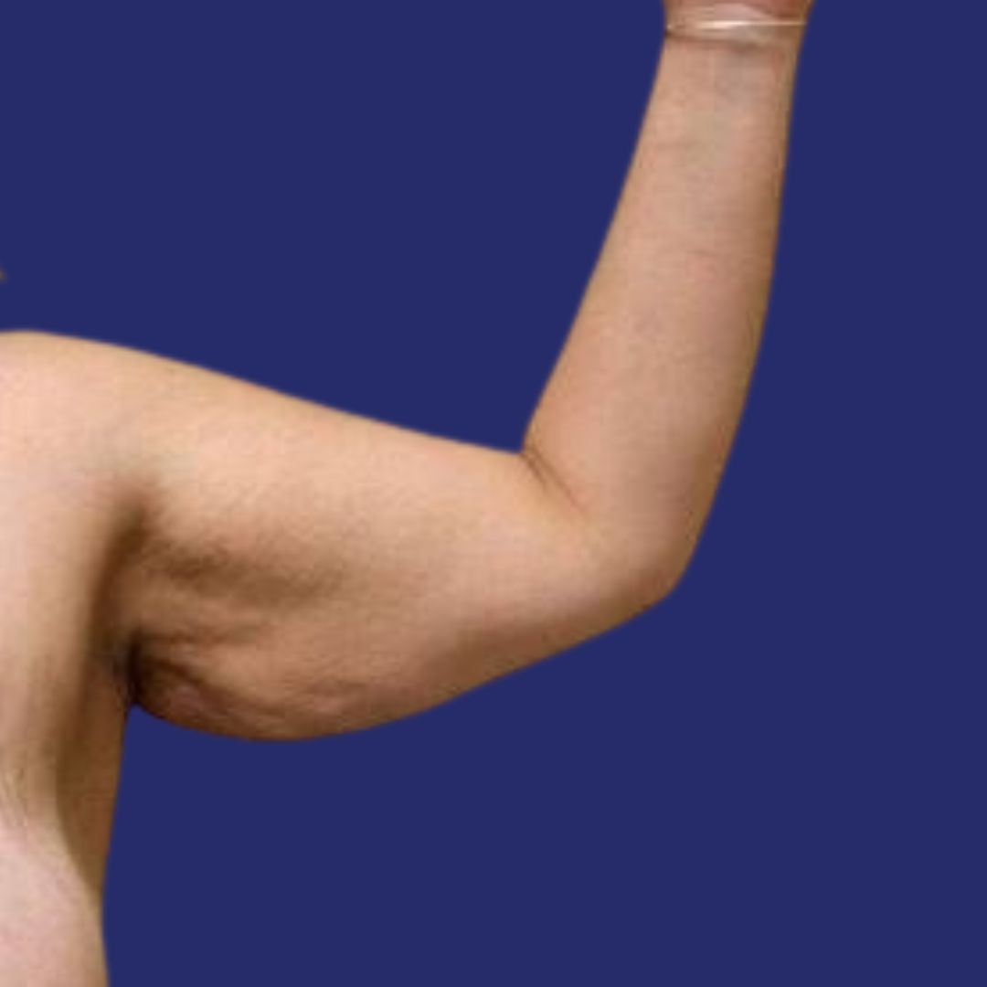 Arm Lift Before and After Photos - Wellness Kliniek