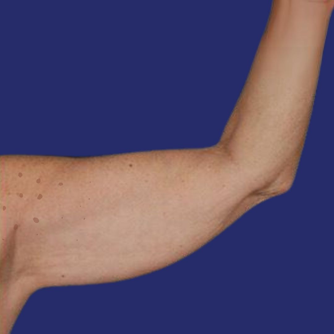 Arm Lift Before and After Photos - Wellness Kliniek